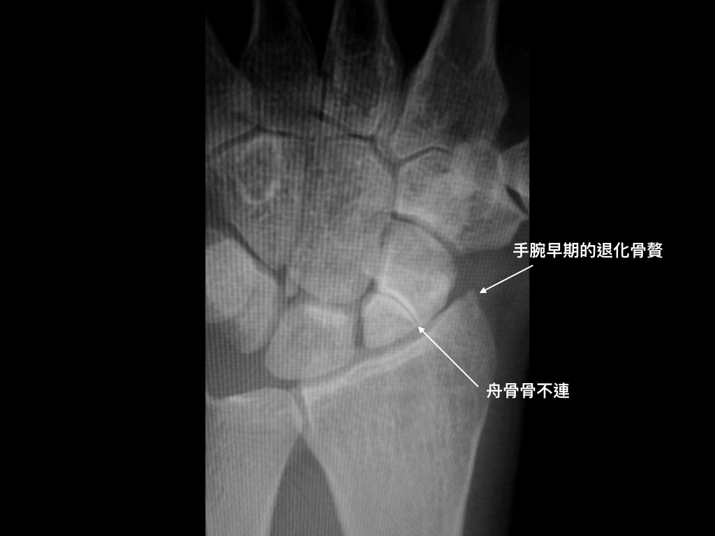 認識手腕骨──舟骨 - 信健康